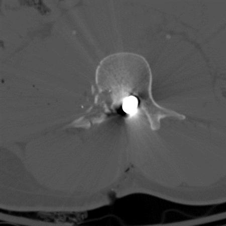 Gun Shot Wounds - Trauma - Orthobullets