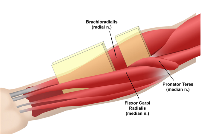 Volar Approach to Radius (Henry) : 네이버 블로그