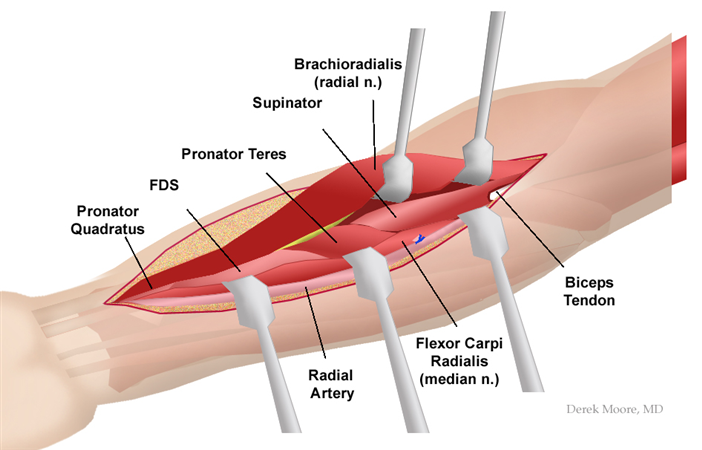 Volar Approach to Radius (Henry) : 네이버 블로그