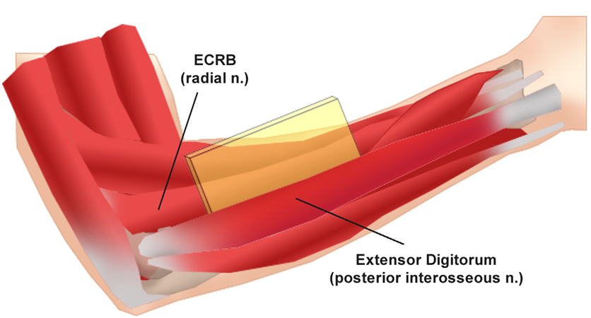Dorsal Approach to Radius (Thompson) : 네이버 블로그