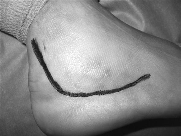 Extensile Lateral Approach to Calcaneus : 네이버 블로그