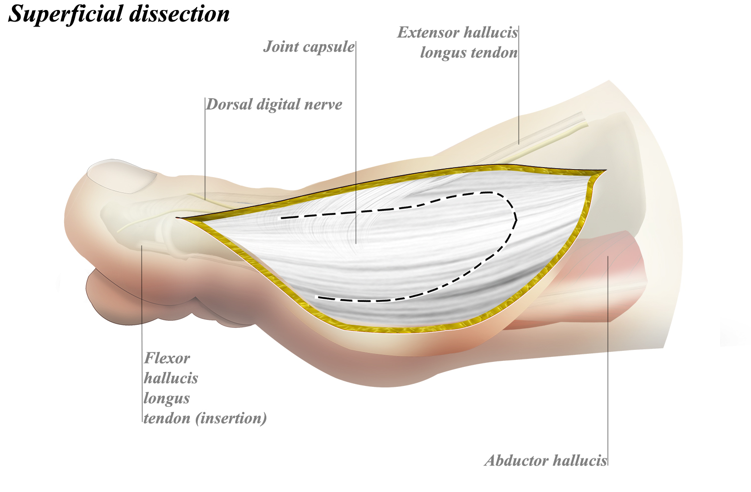 Dorsomedial Approach To MTP Joint Of Great Toe Approaches Orthobullets Dorsomedial Approach To MTP Joint Of Great Toe Approaches Orthobullets