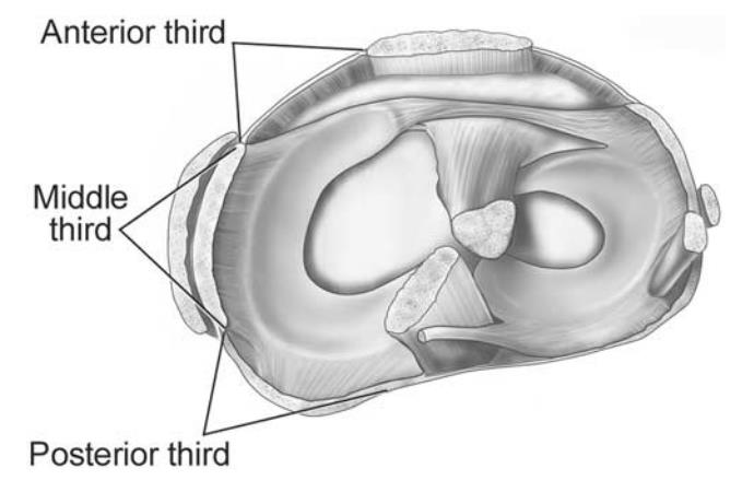 Posteromedial Corner Injury - Knee & Sports - Orthobullets
