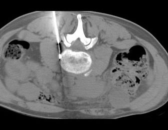 Adult Pyogenic Vertebral Osteomyelitis - Spine - Orthobullets