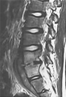 Disk Space Infection - Pediatric - Spine - Orthobullets