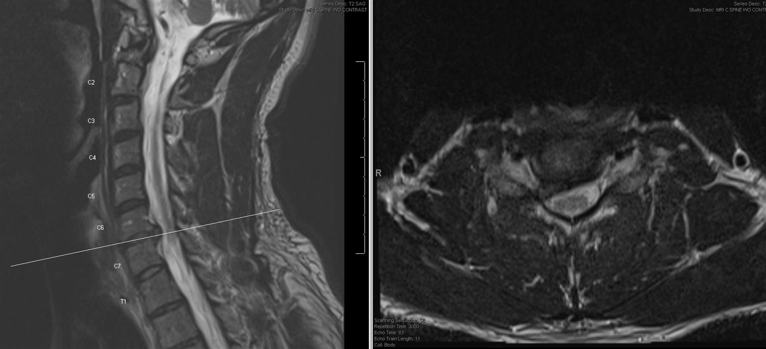 Cervical Radiculopathy Spine Orthobullets Cervical Radiculopathy Spine Orthobullets