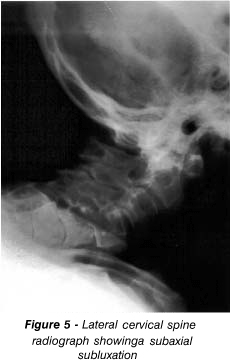Rheumatoid Cervical Spondylitis - Spine - Orthobullets