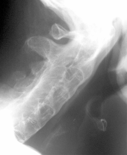 DISH (Diffuse Idiopathic Skeletal Hyperostosis) - Spine - Orthobullets