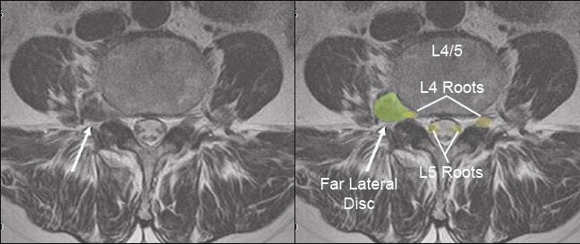 Lumbar Spine Anatomy - Spine - Orthobullets
