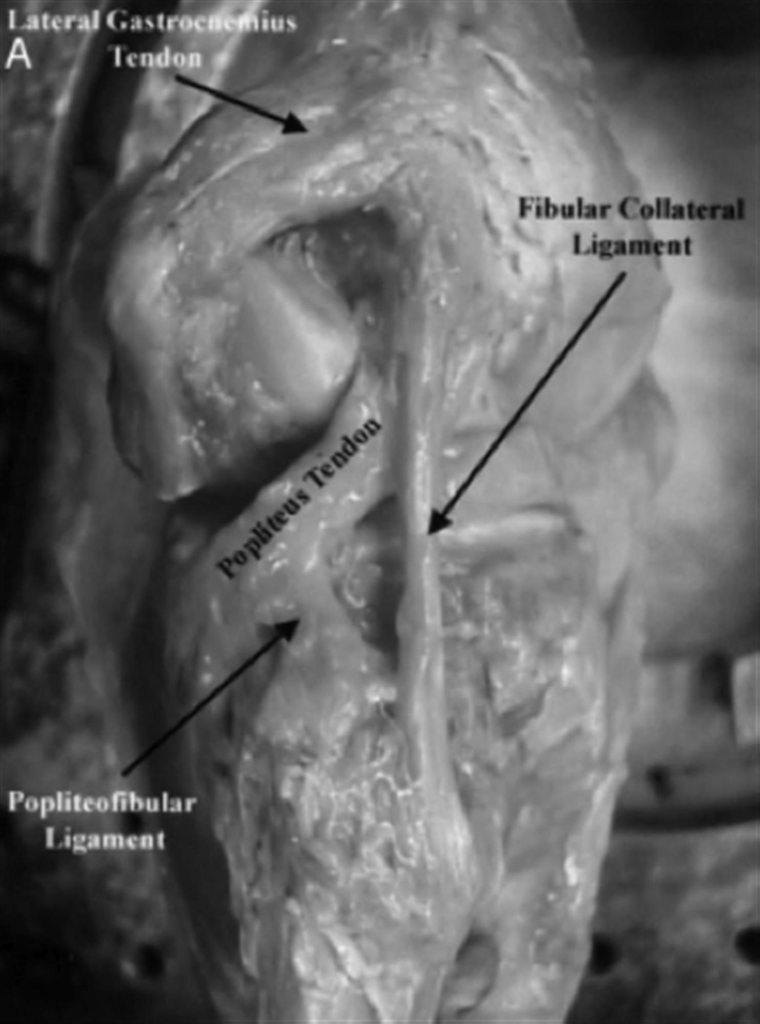 Ligaments of the Knee - Recon - Orthobullets