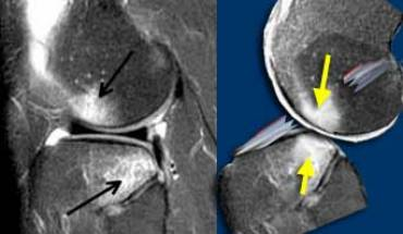 Knee Imaging - Knee & Sports - Orthobullets