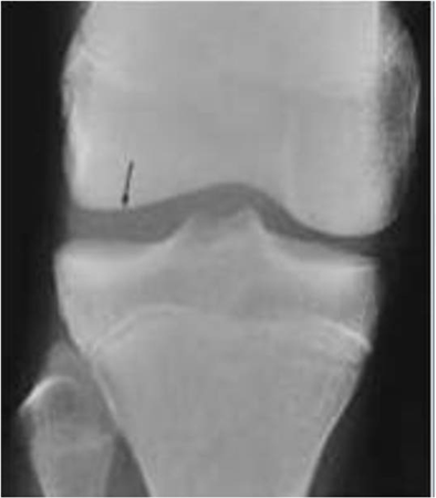 Knee Imaging - Knee & Sports - Orthobullets