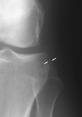 Knee Imaging - Knee & Sports - Orthobullets