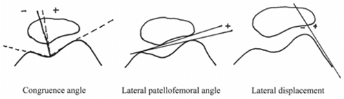 Patellar Instability - Knee & Sports - Orthobullets