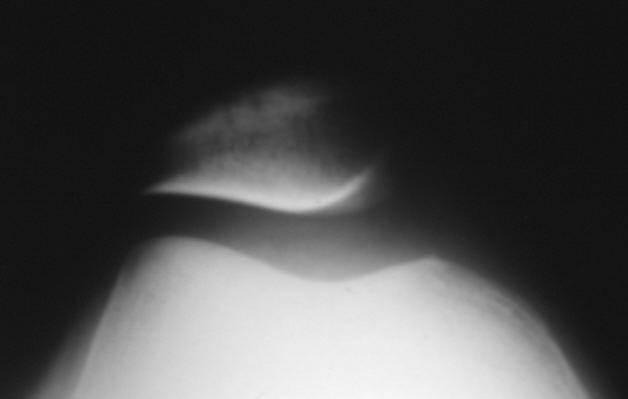 Lateral Patellar Compression Syndrome - Knee & Sports - Orthobullets