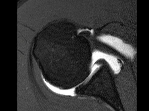 Shoulder Imaging - Shoulder & Elbow - Orthobullets