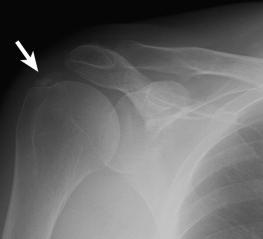 Calcific Tendonitis - Shoulder & Elbow - Orthobullets