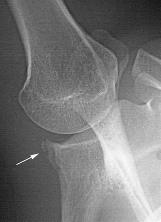 Internal Impingement - Shoulder & Elbow - Orthobullets