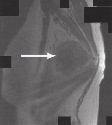Scapulothoracic Crepitus - Shoulder & Elbow - Orthobullets