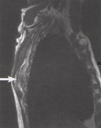 Scapulothoracic Crepitus - Shoulder & Elbow - Orthobullets