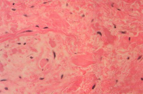 Scapulothoracic Crepitus - Shoulder & Elbow - Orthobullets