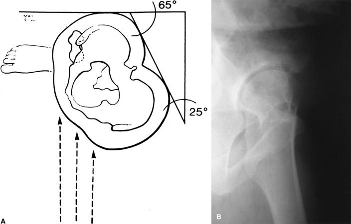 Femoroacetabular Impingement (FAI) - Knee & Sports - Orthobullets