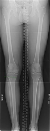 Articular Cartilage Defects of Knee - Knee & Sports - Orthobullets