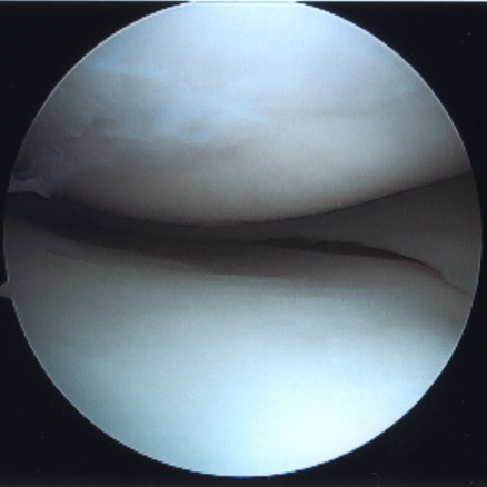 Articular Cartilage Defects of Knee - Knee & Sports - Orthobullets