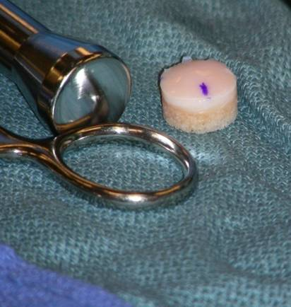 Articular Cartilage Defects of Knee - Knee & Sports - Orthobullets