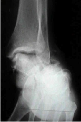Subtalar Dislocations - Trauma - Orthobullets