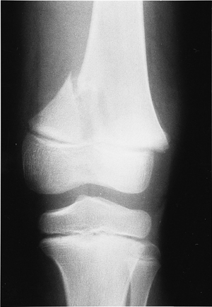 Physeal Considerations - Pediatrics - Orthobullets