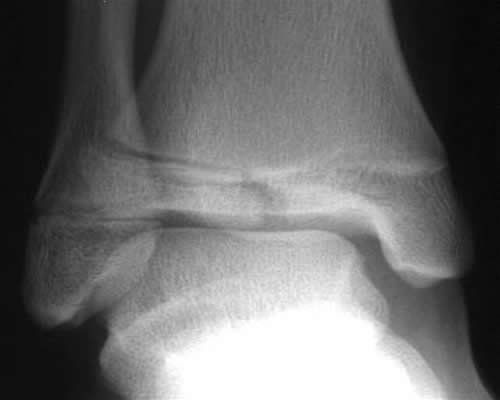 Physeal Considerations - Pediatrics - Orthobullets