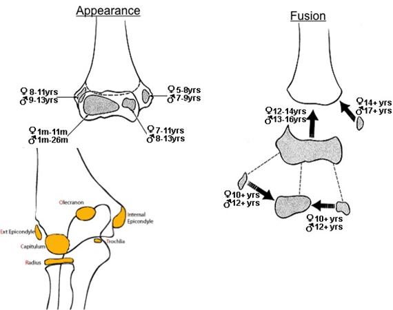 Olecranon Fractures - Pediatric - Pediatrics - Orthobullets