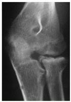 Radial Head and Neck Fractures - Pediatric - Pediatrics - Orthobullets