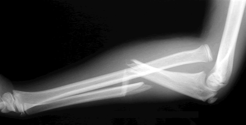 Distal Radius Fractures - Pediatric - Pediatrics - Orthobullets