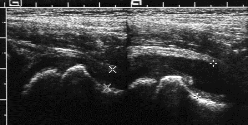 Hip Septic Arthritis - Pediatric - Pediatrics - Orthobullets