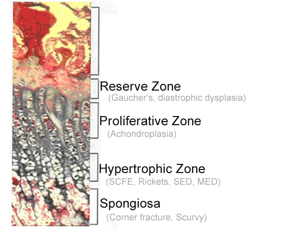 Slipped Capital Femoral Epiphysis (SCFE) - Pediatrics - Orthobullets