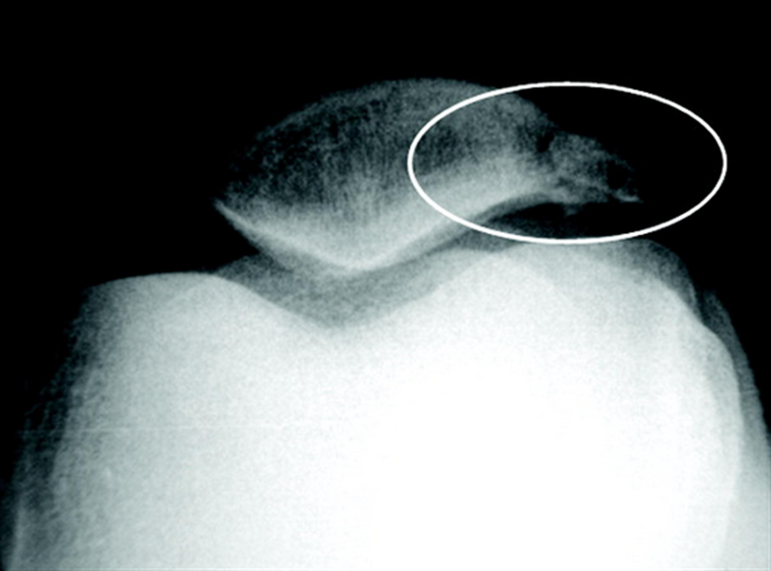 Bipartite Patella - Pediatrics - Orthobullets
