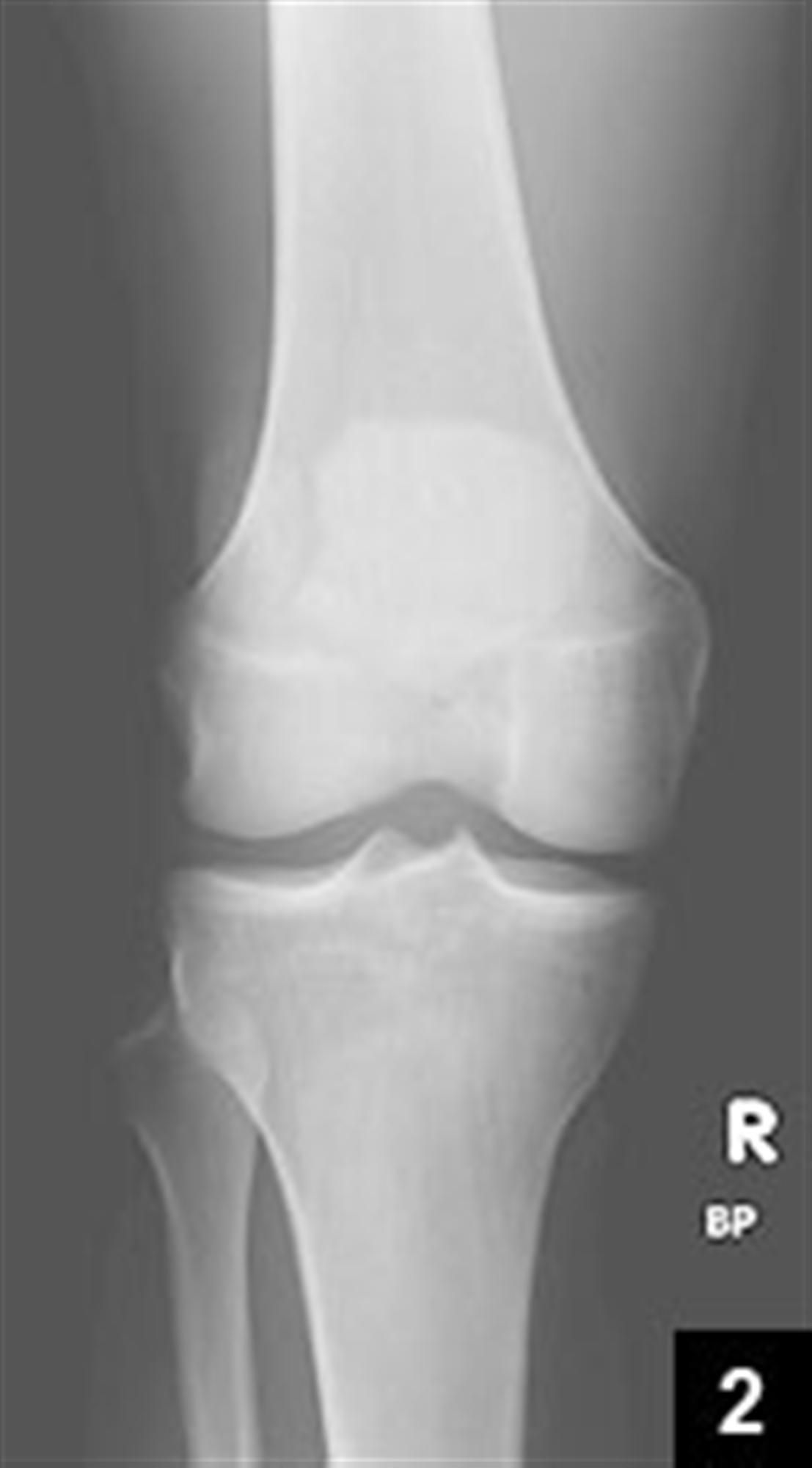 Bipartite Patella - Pediatrics - Orthobullets