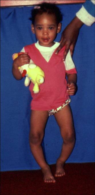 Infantile Blount's Disease (tibia vara) - Pediatrics - Orthobullets