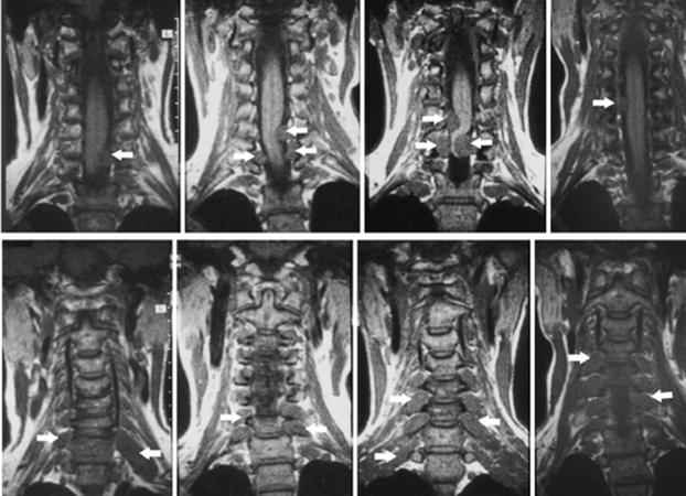 Neurofibroma - Pathology - Orthobullets