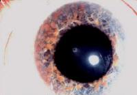 Neurofibromatosis - Pediatrics - Orthobullets