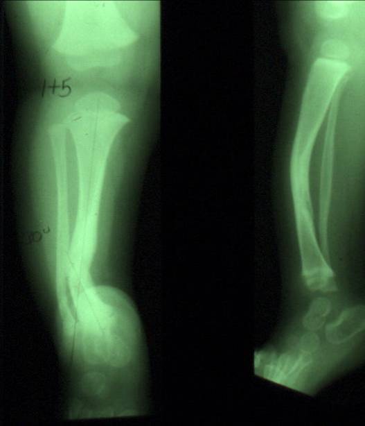 Neurofibromatosis - Pediatrics - Orthobullets