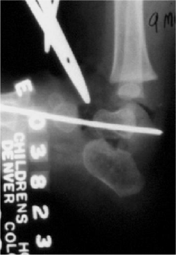 Congenital Vertical Talus - Pediatrics - Orthobullets