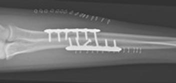 Both Bone Fracture - Pediatric : 네이버 블로그