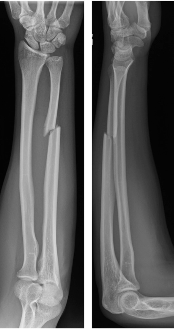 Ulna Fracture Ulna Fracture