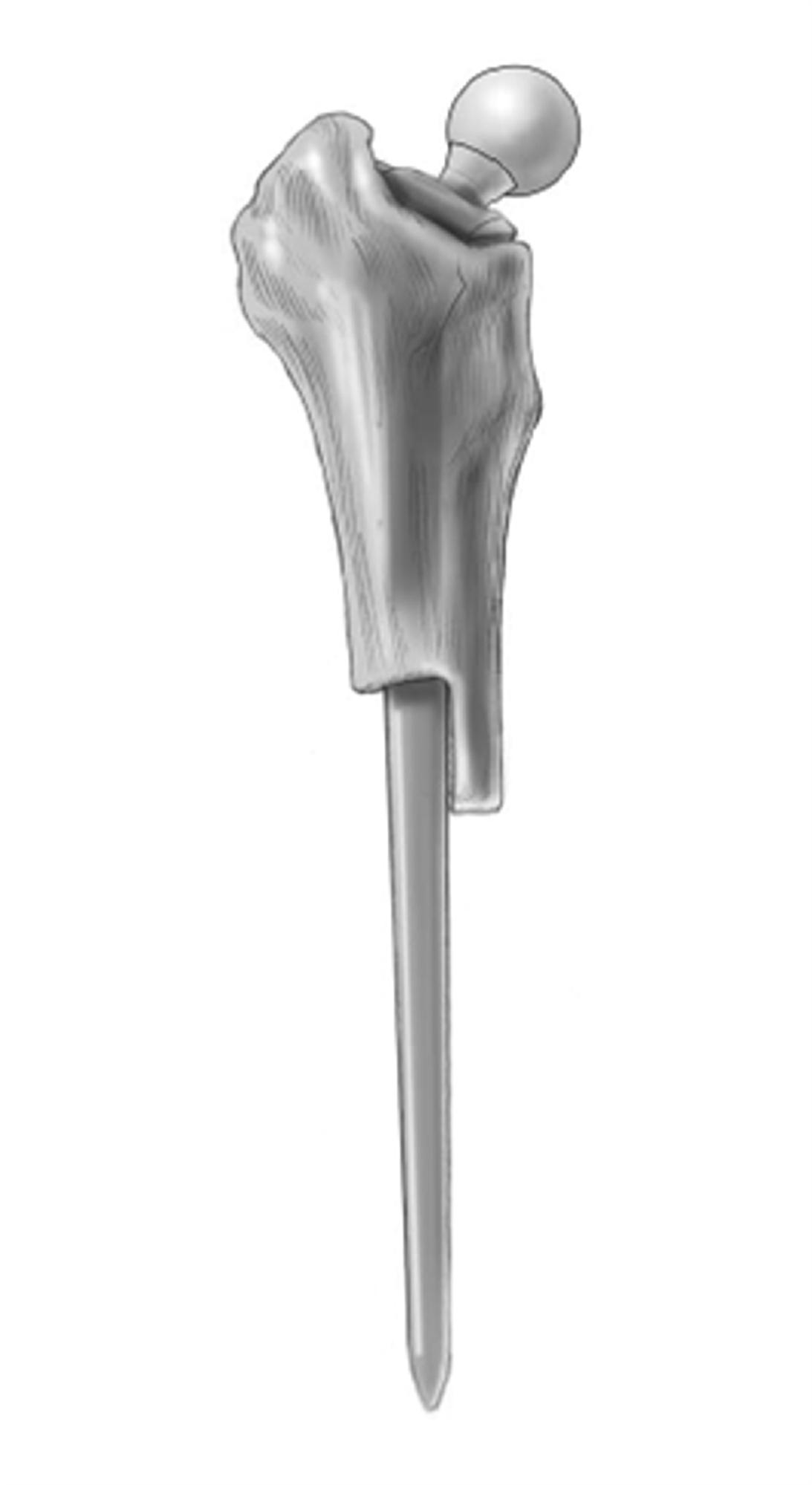 THA Revision - Recon - Orthobullets