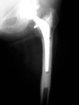 THA Revision - Recon - Orthobullets