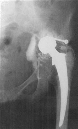 THA Revision - Recon - Orthobullets