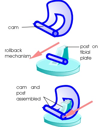 TKA Prosthesis Design - Recon - Orthobullets